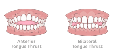 Oral Habits and Orthodontics