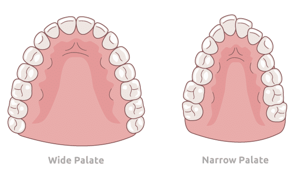 Oral Habits and Orthodontics