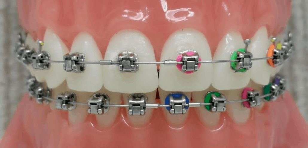 Why Damon Braces?